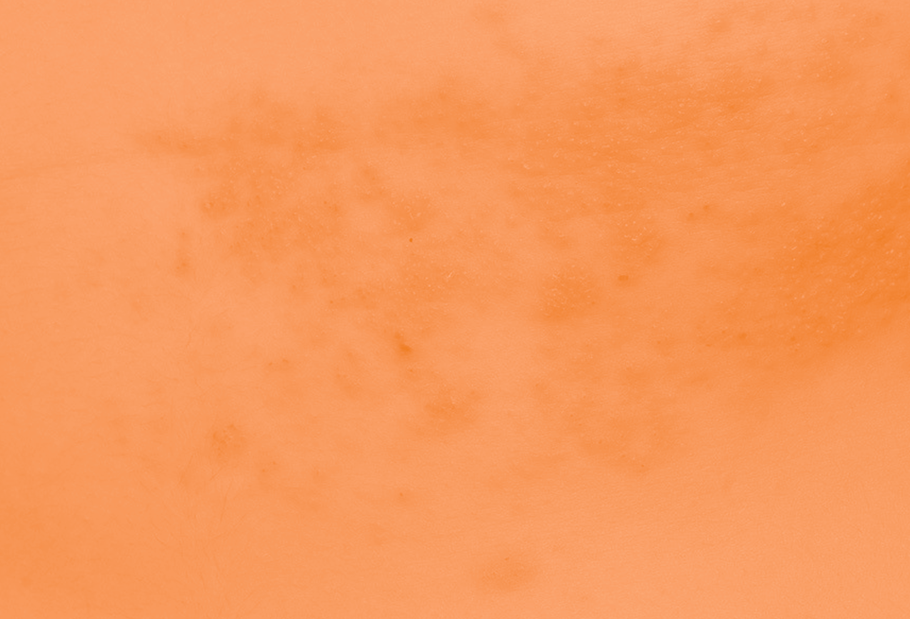 Skin Ailment (Ringworm, Shingles, Impetigo, etc…) » Afterhours Urgent ...